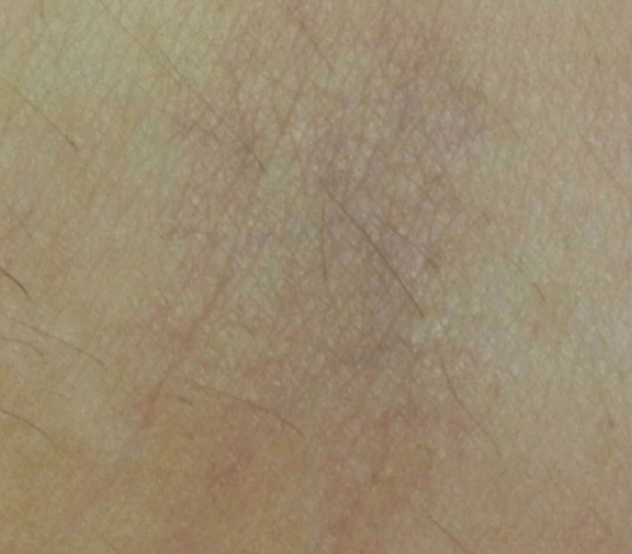 Clarity II™ - Seriderm